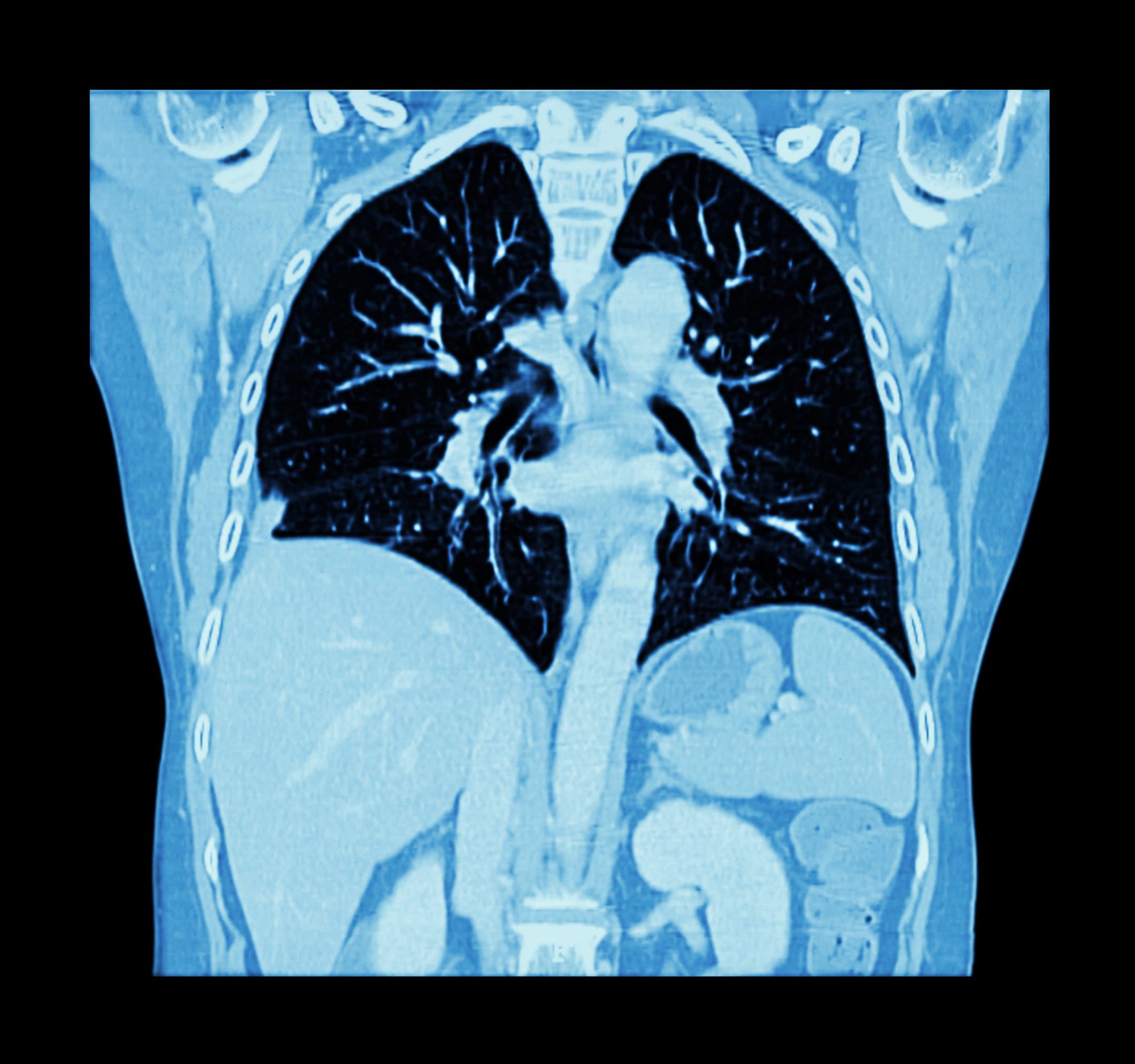 CT Lung Tumors, 3-D Reconstruction - Get Your CEU - Instant Certificate
